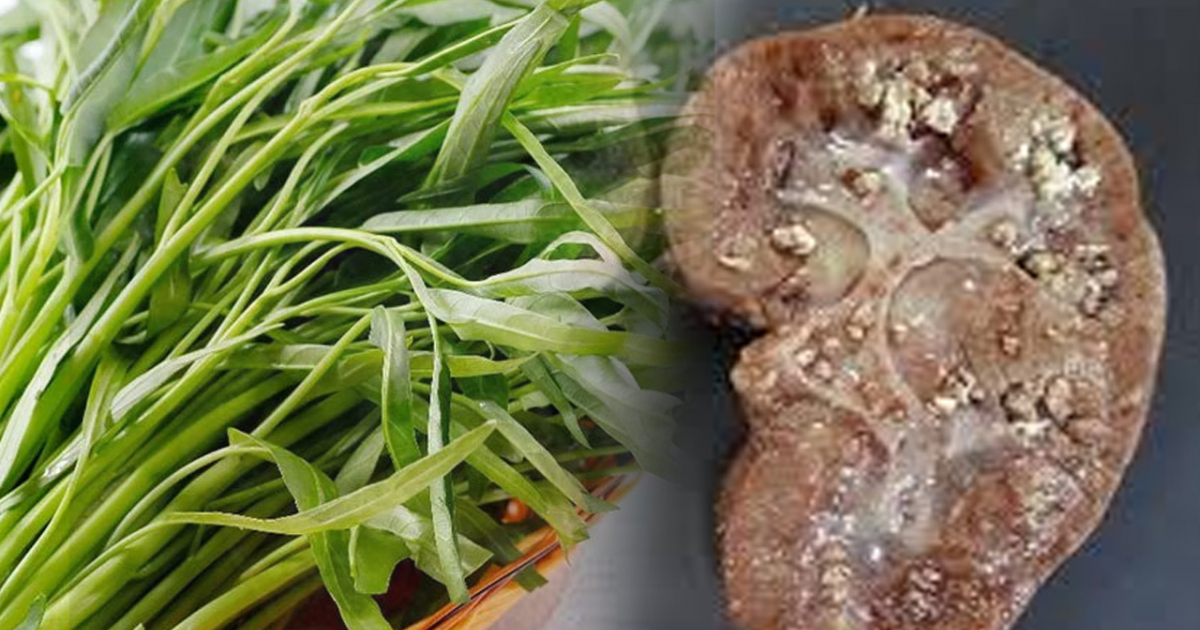 3 loại rau được người Việt ưa thích nhưng ăn nhiều nguy cơ sỏi thận